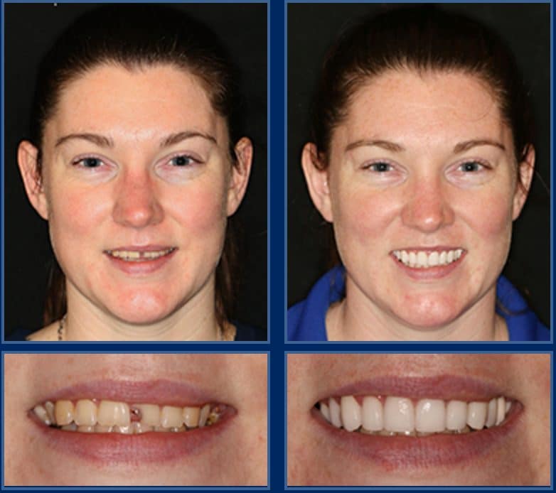 Affordable Dental Implants Just In Time for a Beautiful Summer Smile ...