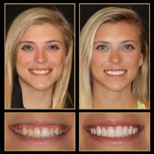 Smile Makeover Austin - Full Mouth Smile Restoration Austin TX