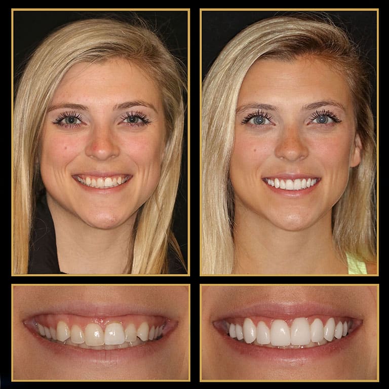 Smile Makeover Austin - Full Mouth Smile Restoration Austin TX