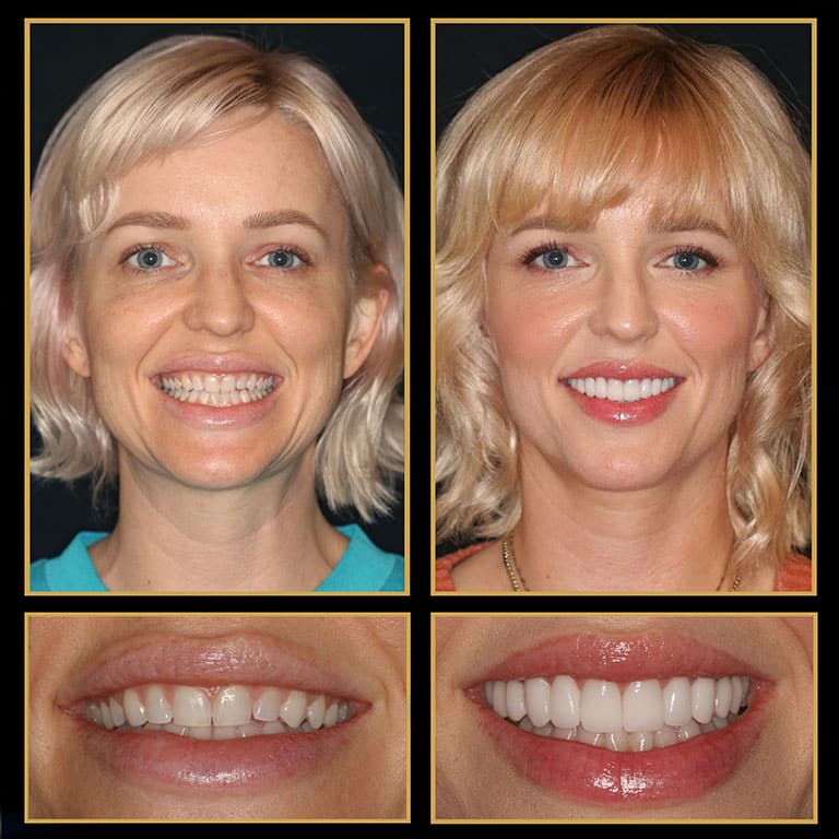 Smile Makeover Austin - Full Mouth Smile Restoration Austin TX